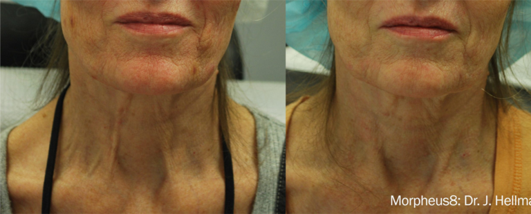 Body Contouring - Hurst Med